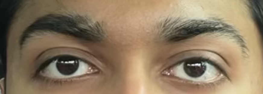 Eye surgery morph advice | Looksmax.org - Men's Self-Improvement ...