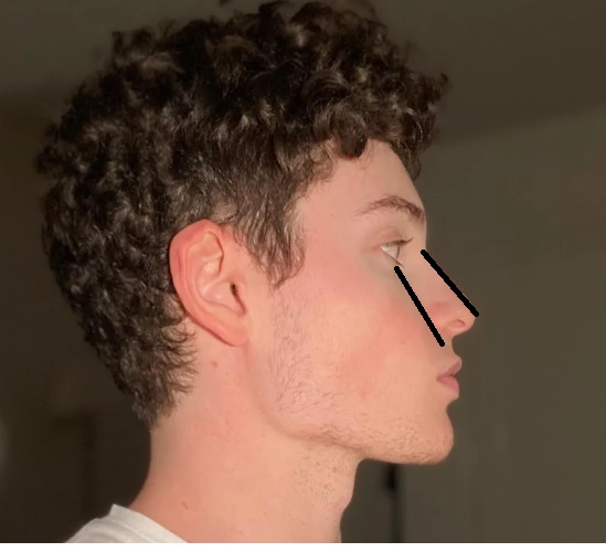 For ideal maxilla+nose aesthetics you want these two lines to be ...