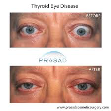 Hypothyroidism can cause scleral show and UEE | Looksmax.org - Men's ...