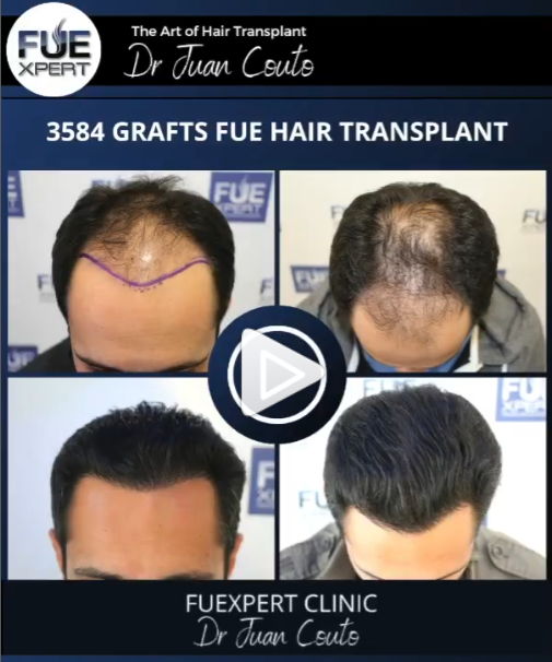 In the clinic where Brett Maverick did a hair transplant they ...