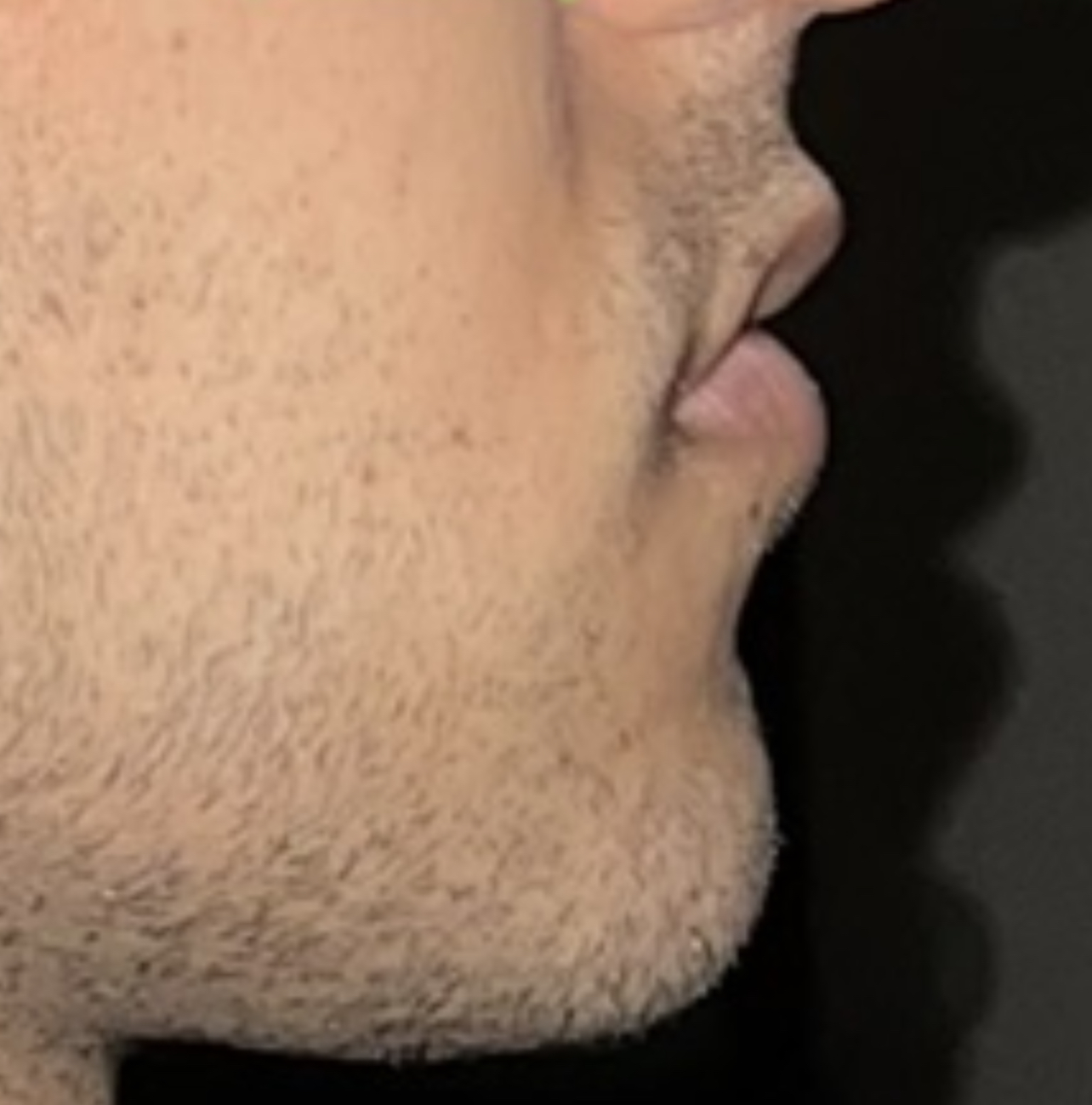 My top lip curls inward or is it me? What is this? | Looksmax.org - Men ...