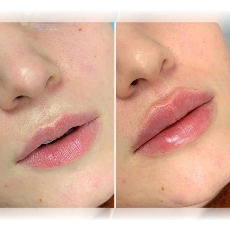 lip filler that fix a long philtrum? | Looksmax.org - Men's Self ...