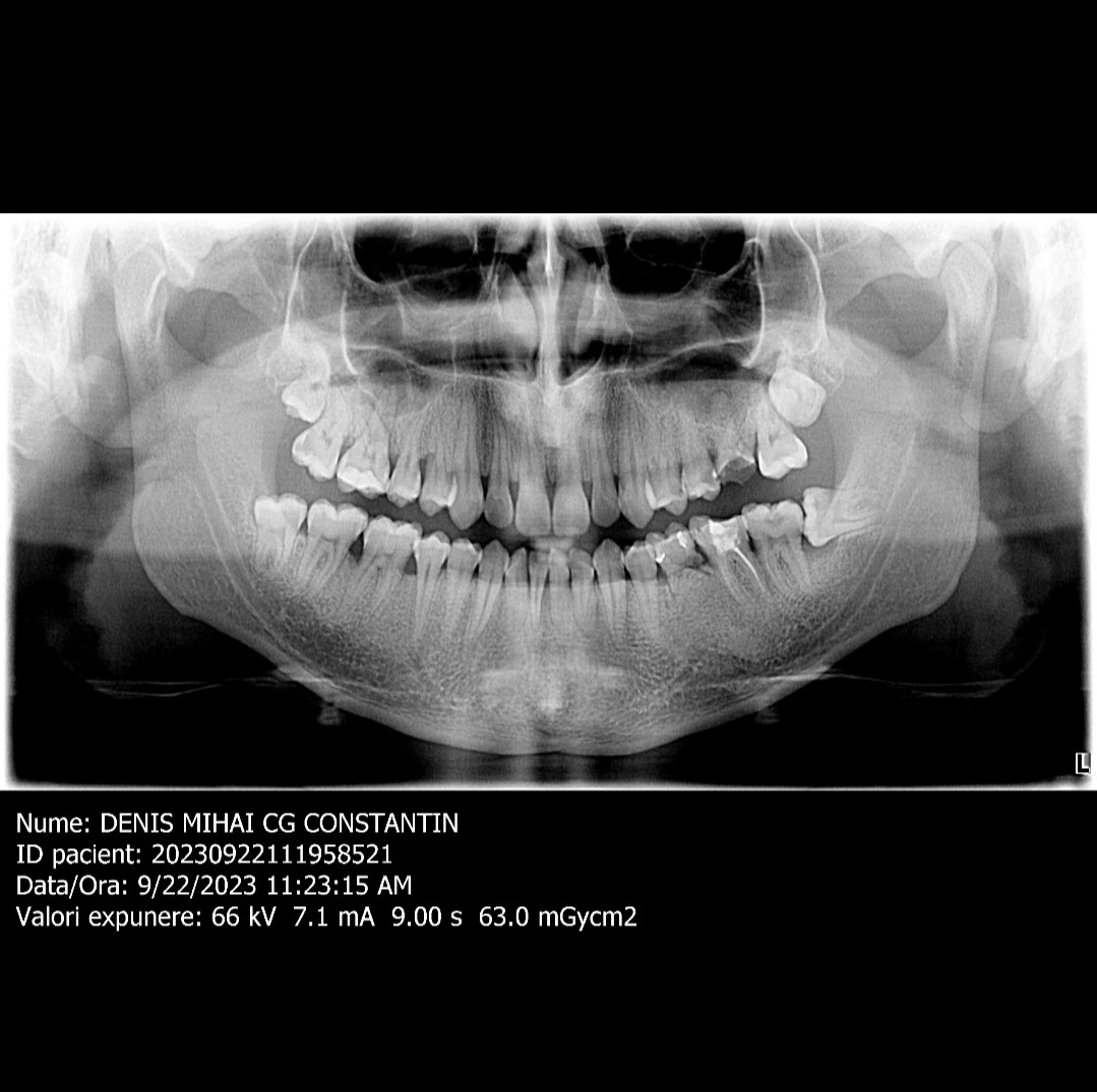 Can you tell if paranasal area is recessed from jaw x ray ? (pic ...