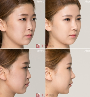Fillers vs implants | Looksmax - Men's Self-Improvement & Aesthetics