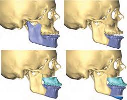 CHIN HEIGHT SURGERY | Looksmax.org - Men's Self-Improvement & Aesthetics