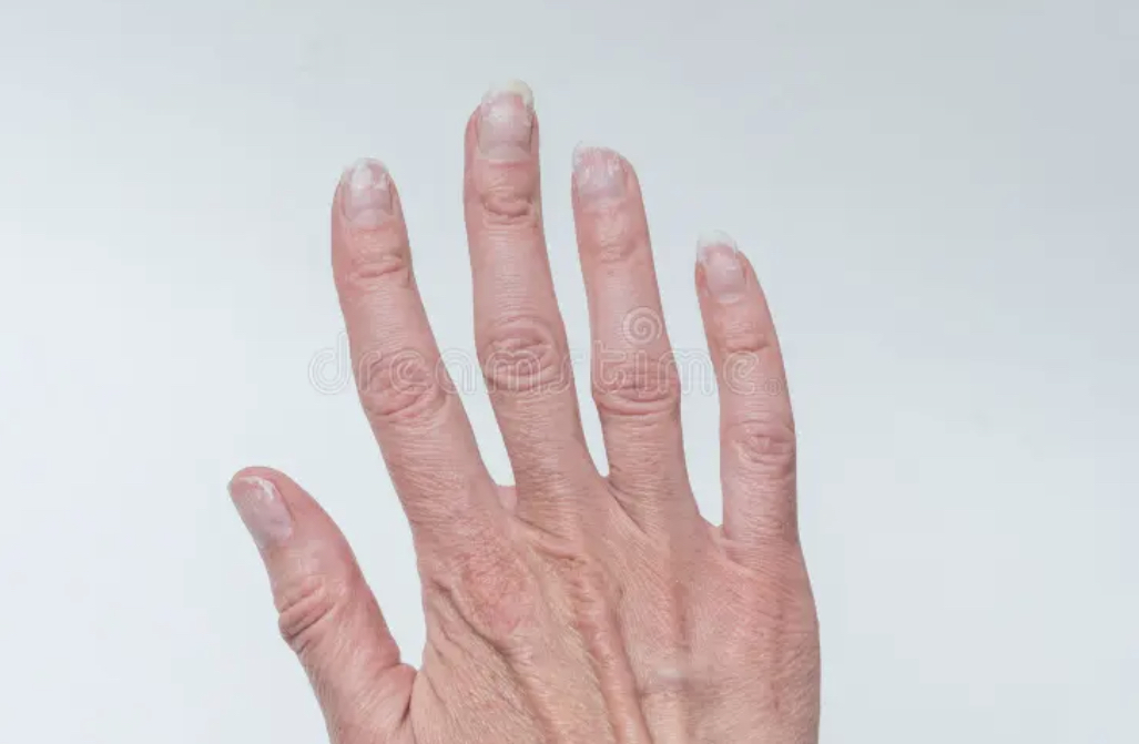 Crooked finger | Looksmax.org - Men's Self-Improvement & Aesthetics