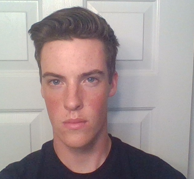What is worse to have Long Midface or long chin to philtrum ratio 3.0 ...