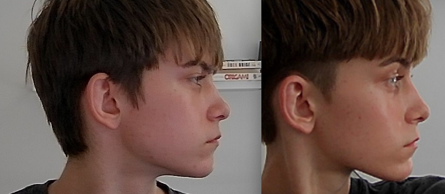 i think mewing made my forward growth worse? | Looksmax.org - Men's ...