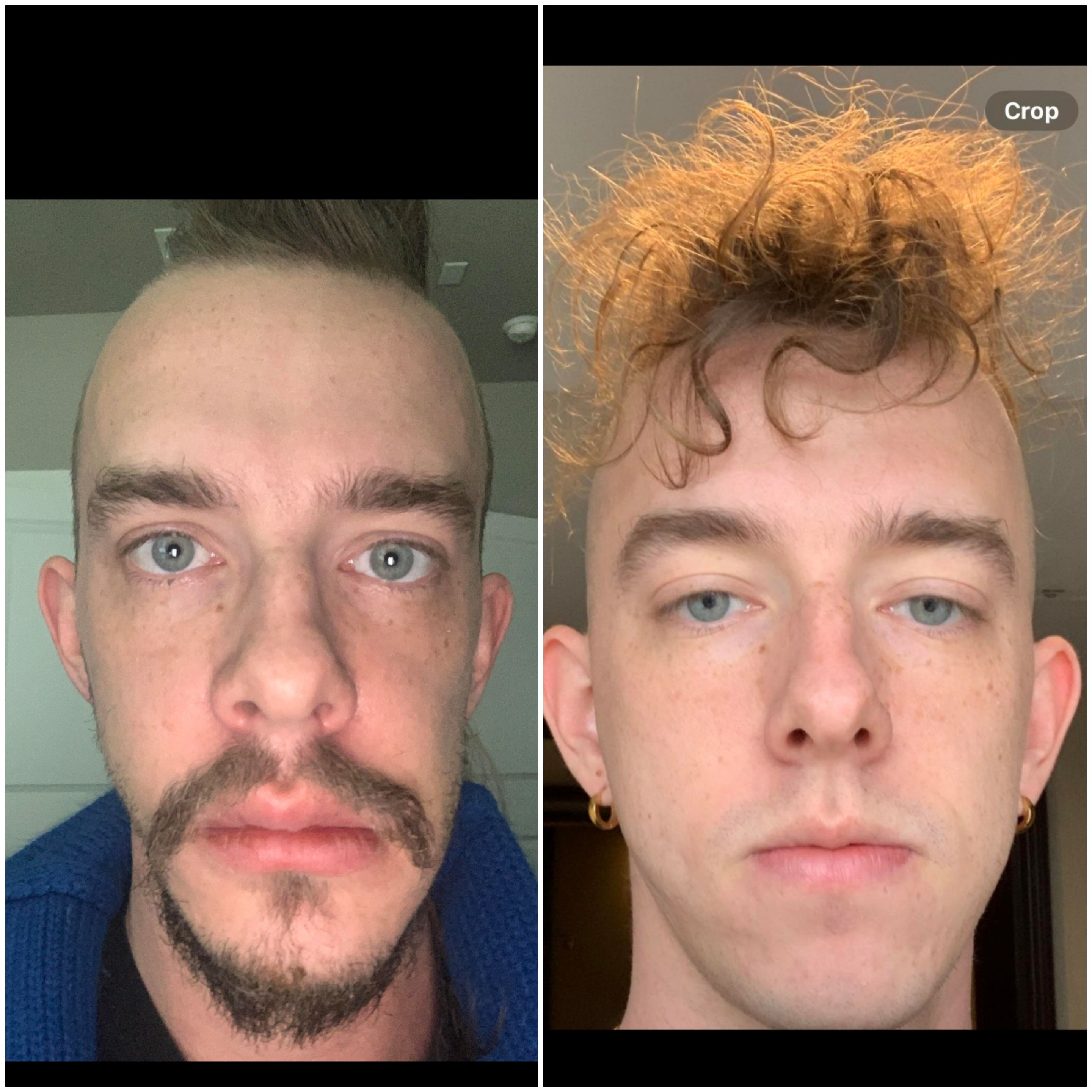 Worst botched "trijaw"i've seen | Looksmax - Men's Self-Improvement ...