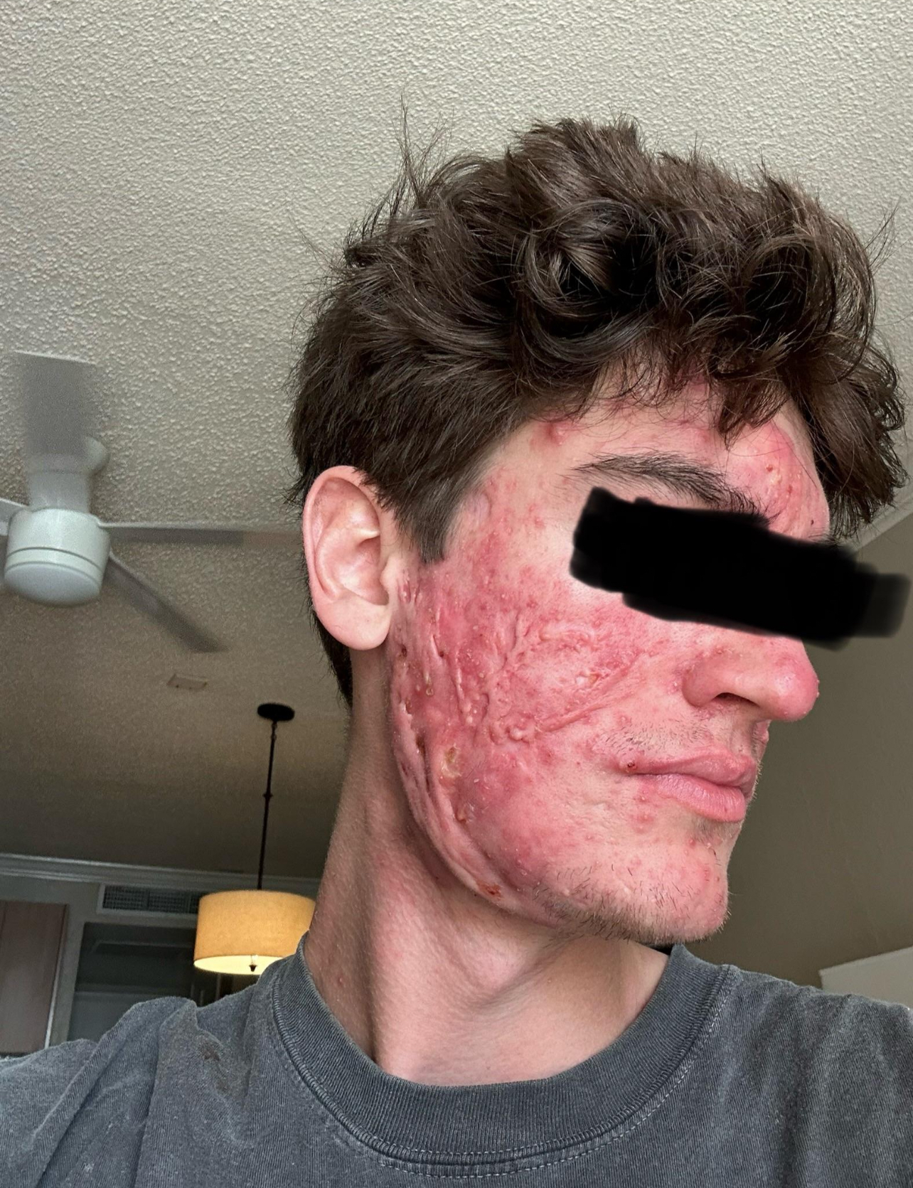 Is it over for my skin? Used to be chadlite | Looksmax.org - Men's Self ...
