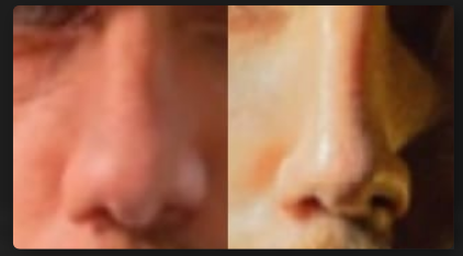 Bimatoprost for refined nasal tip (nose thinning) | Looksmax.org - Men ...