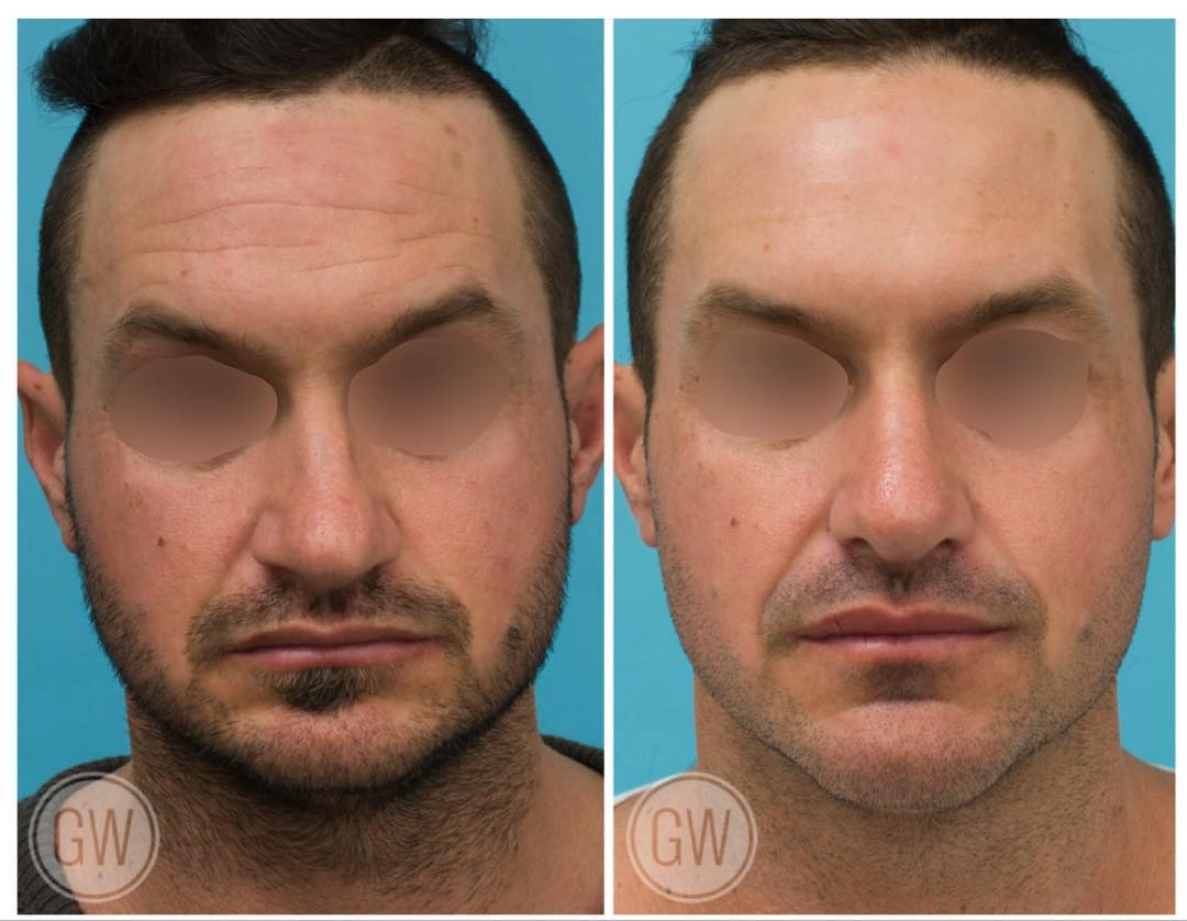 Is achieving a V-shaped jaw and chin possible? | Looksmax - Men's Self ...
