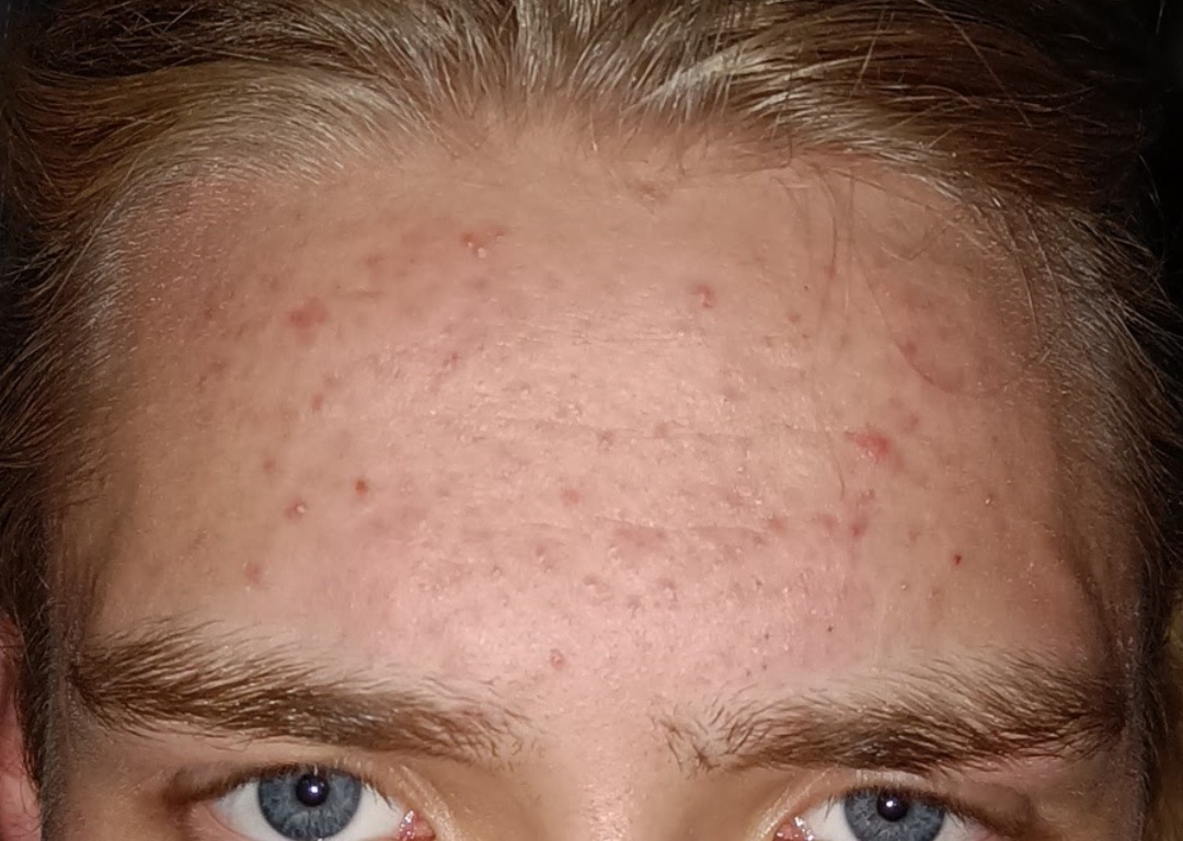 Adapalene cured forehead lines | Looksmax.org - Men's Self-Improvement ...