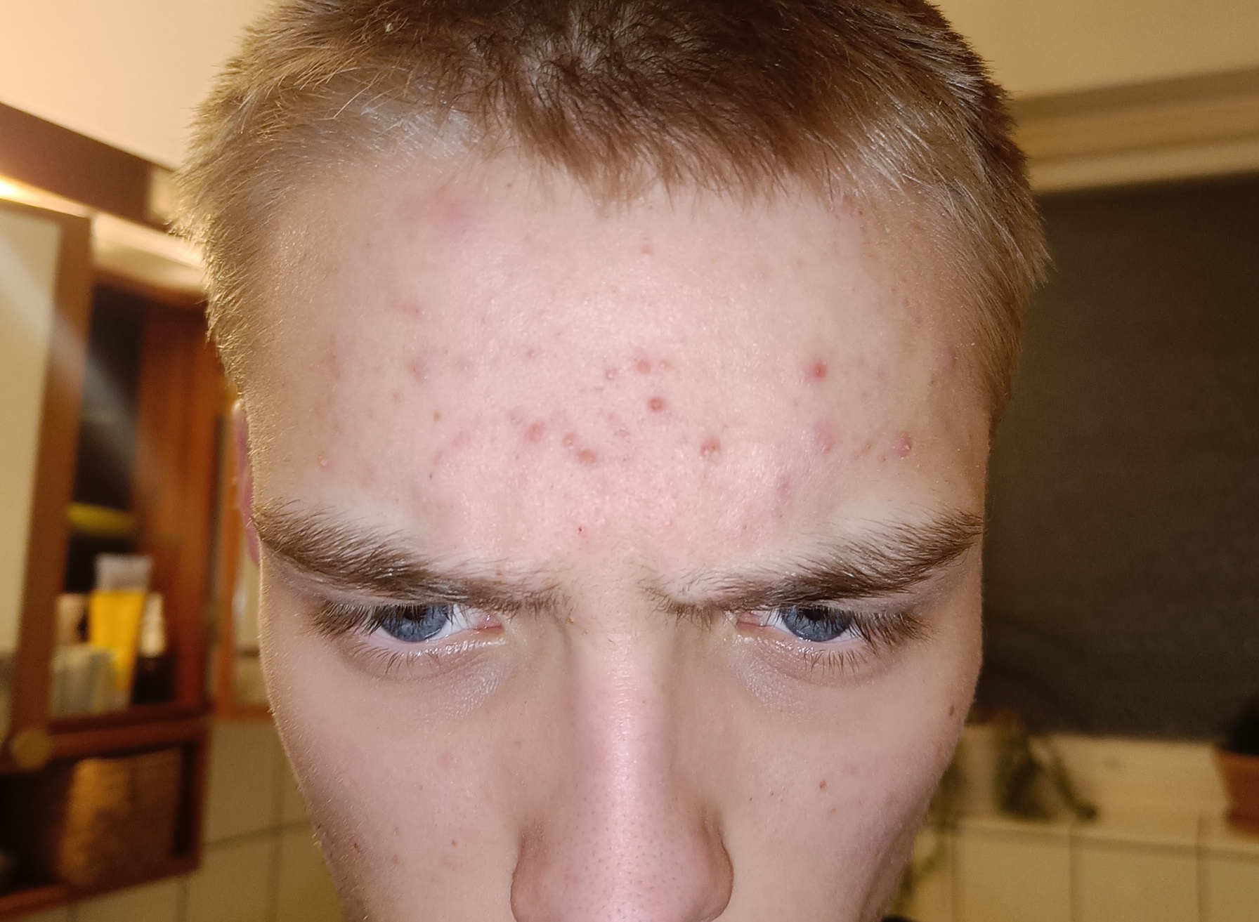 Adapalene cured forehead lines | Looksmax.org - Men's Self-Improvement ...