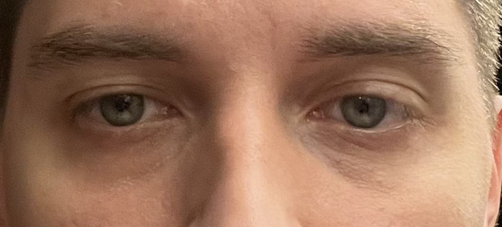 Any solution for dark circles under eye? | Looksmax.org - Men's Self ...