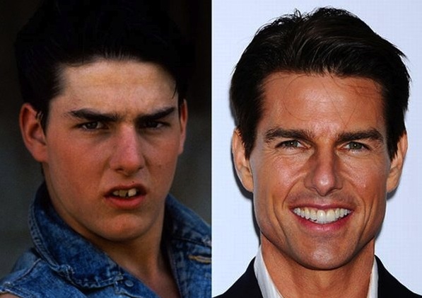 Veneers is the best instant looks max | Looksmax - Men's Self ...