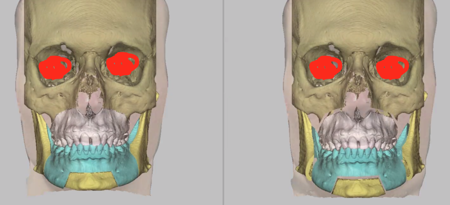 My bimax plan with before/after | Looksmax.org - Men's Self-Improvement ...