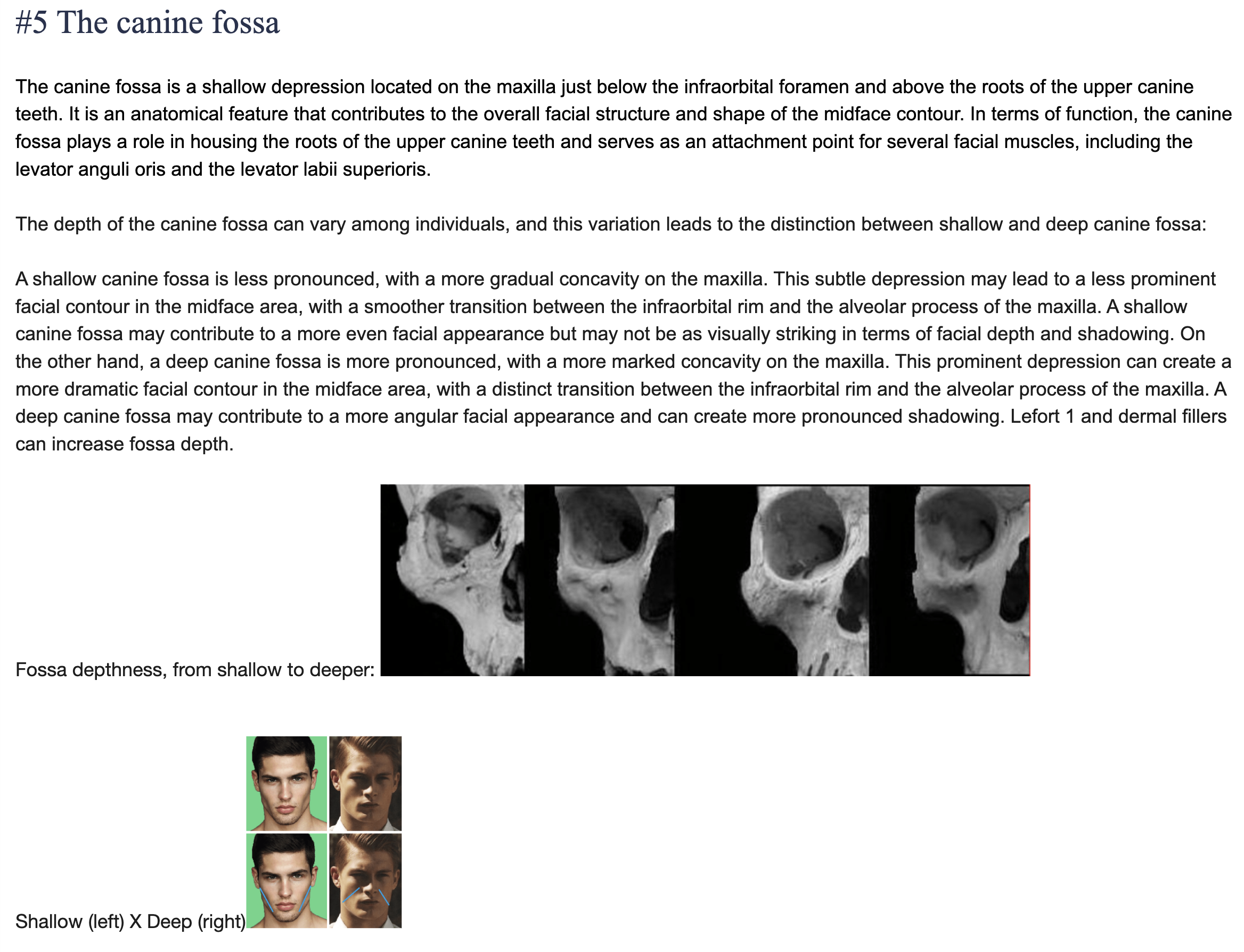 [BIG BRAINS GTFIH] Should the depth of Canine Fossa determine cheekbone ...