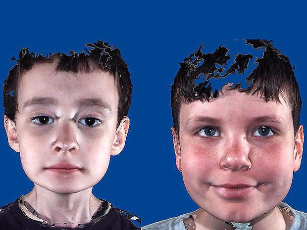 Autism face features! | Looksmax.org - Men's Self-Improvement & Aesthetics