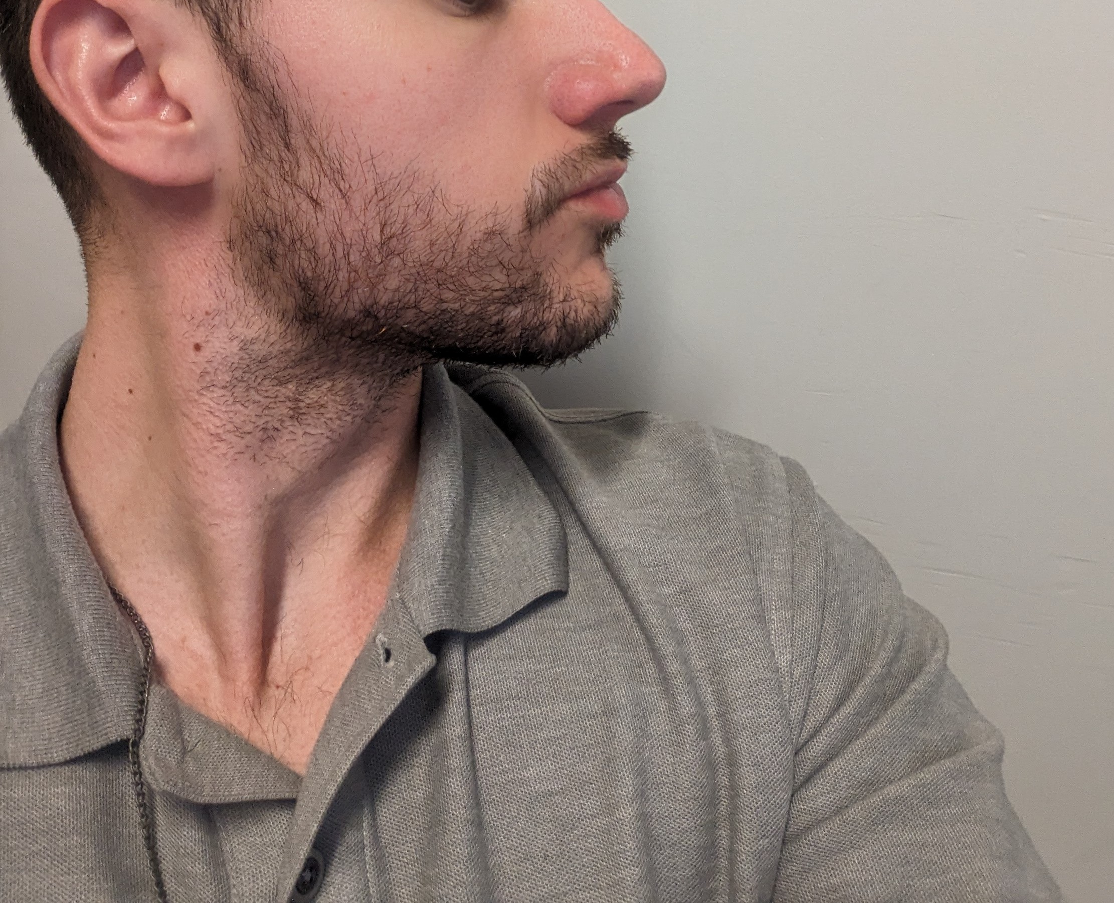 Would I benefit more from a rhinoplasty or a custom wrap around jaw ...