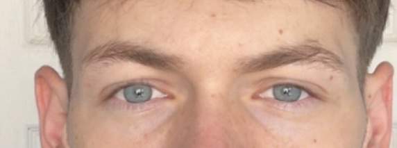 why does my eye area look so bad? | Looksmax.org - Men's Self ...