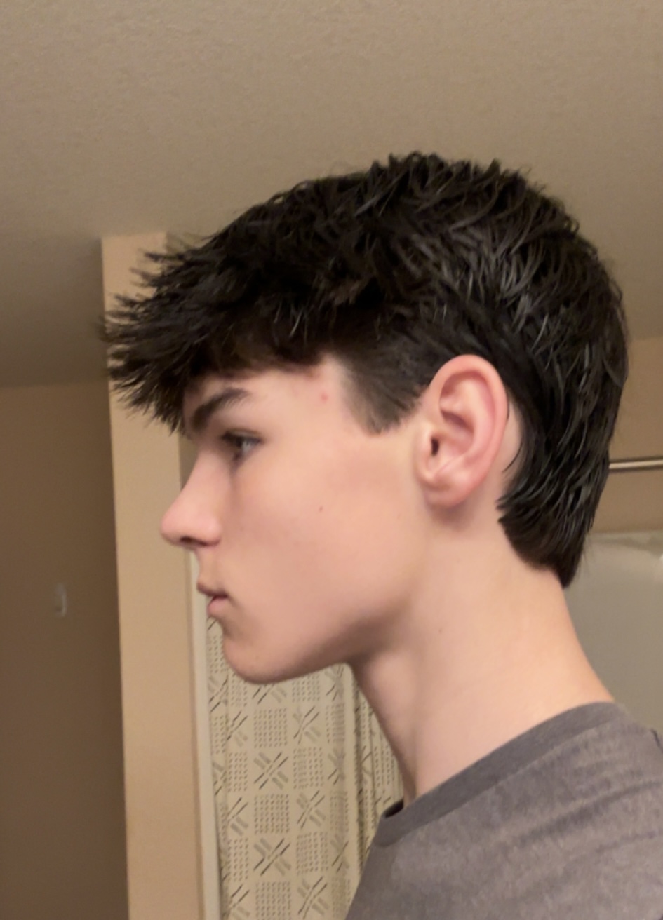 are my infras recessed and if not why do i have subhuman eye bags (i ...