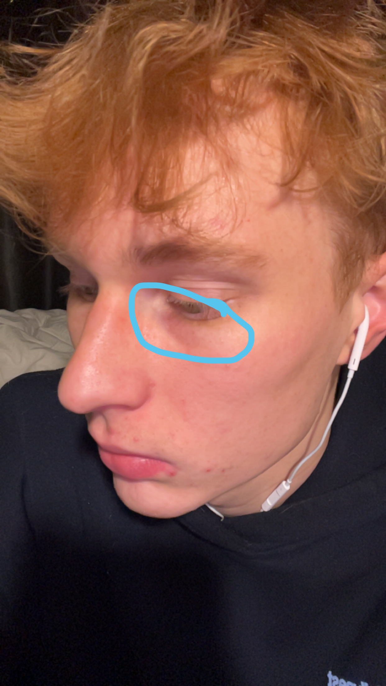recessed infraorbital rims ? | Looksmax - Men's Self-Improvement ...