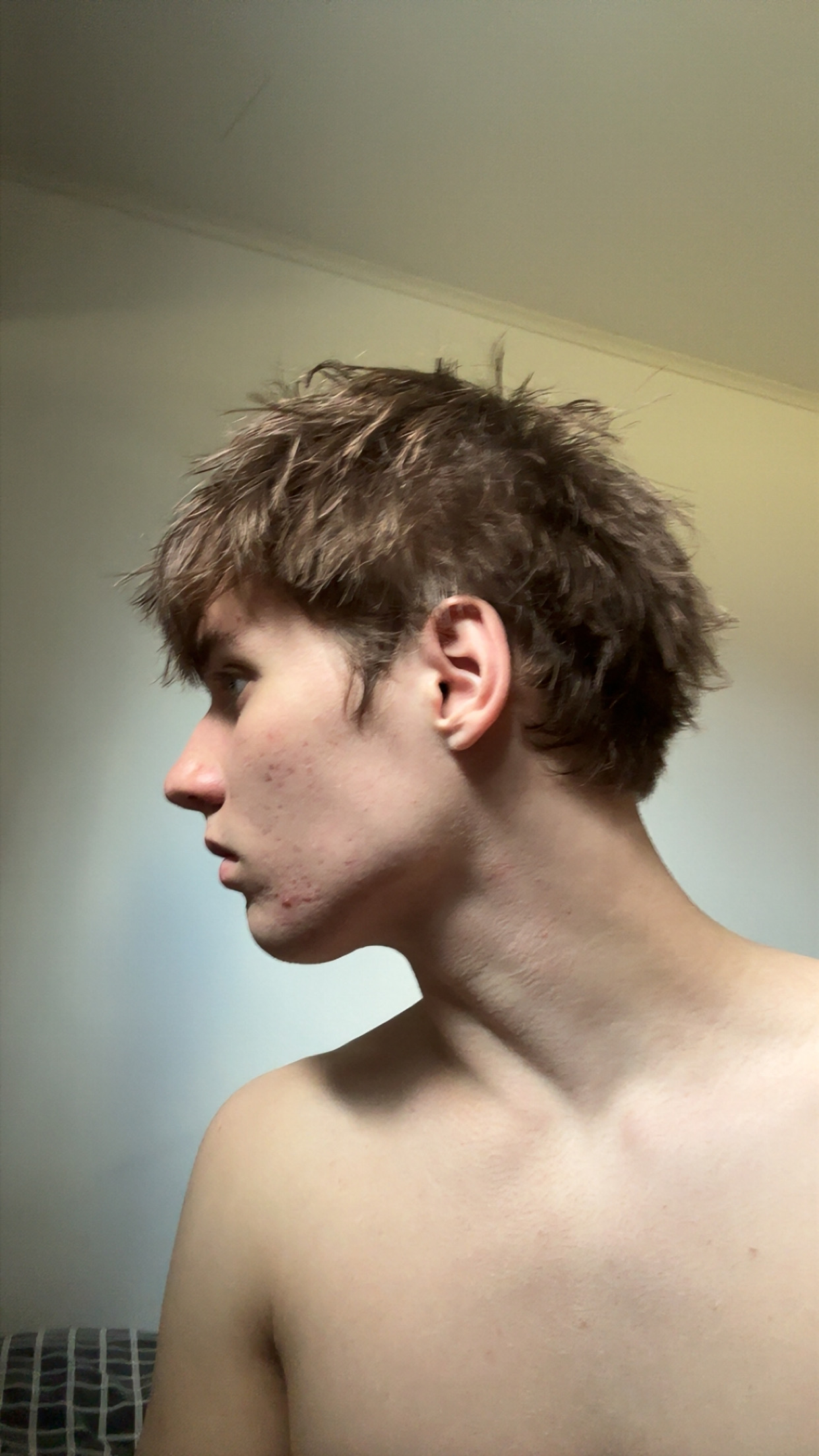 How do I get rid of my acne scars? | Looksmax.org - Men's Self ...