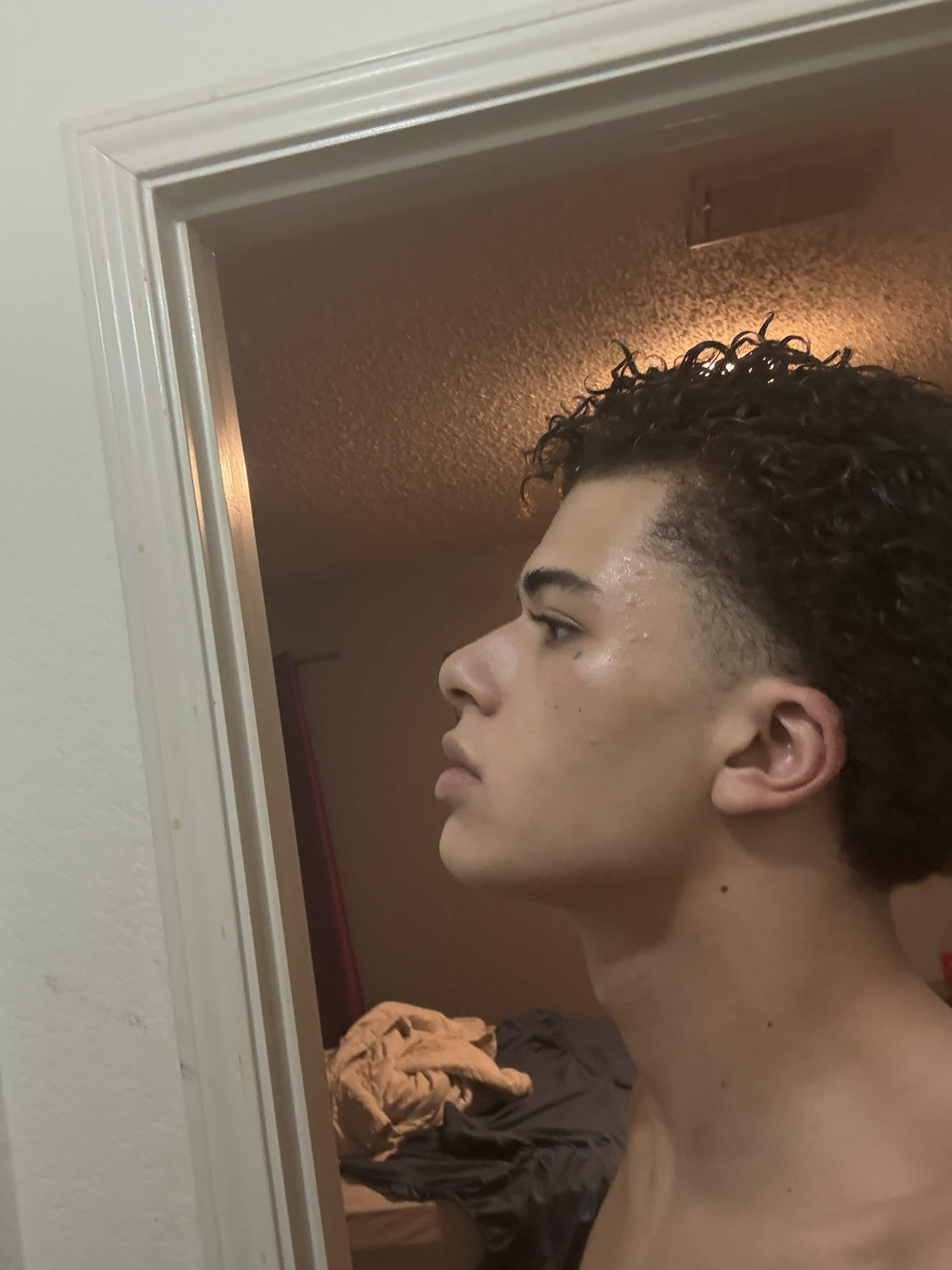 Filler Is Meta (B&A) Example | Looksmax.org - Men's Self-Improvement ...