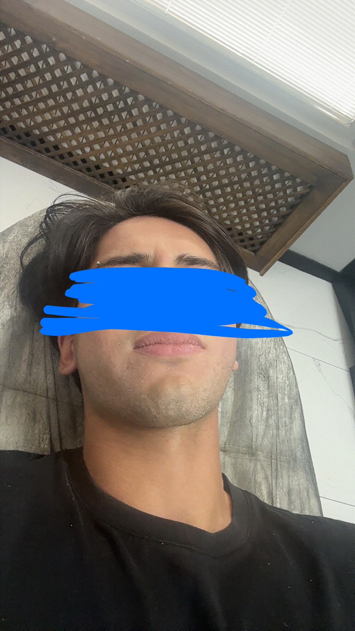 Just had buccal fat removal | Looksmax.org - Men's Self-Improvement ...