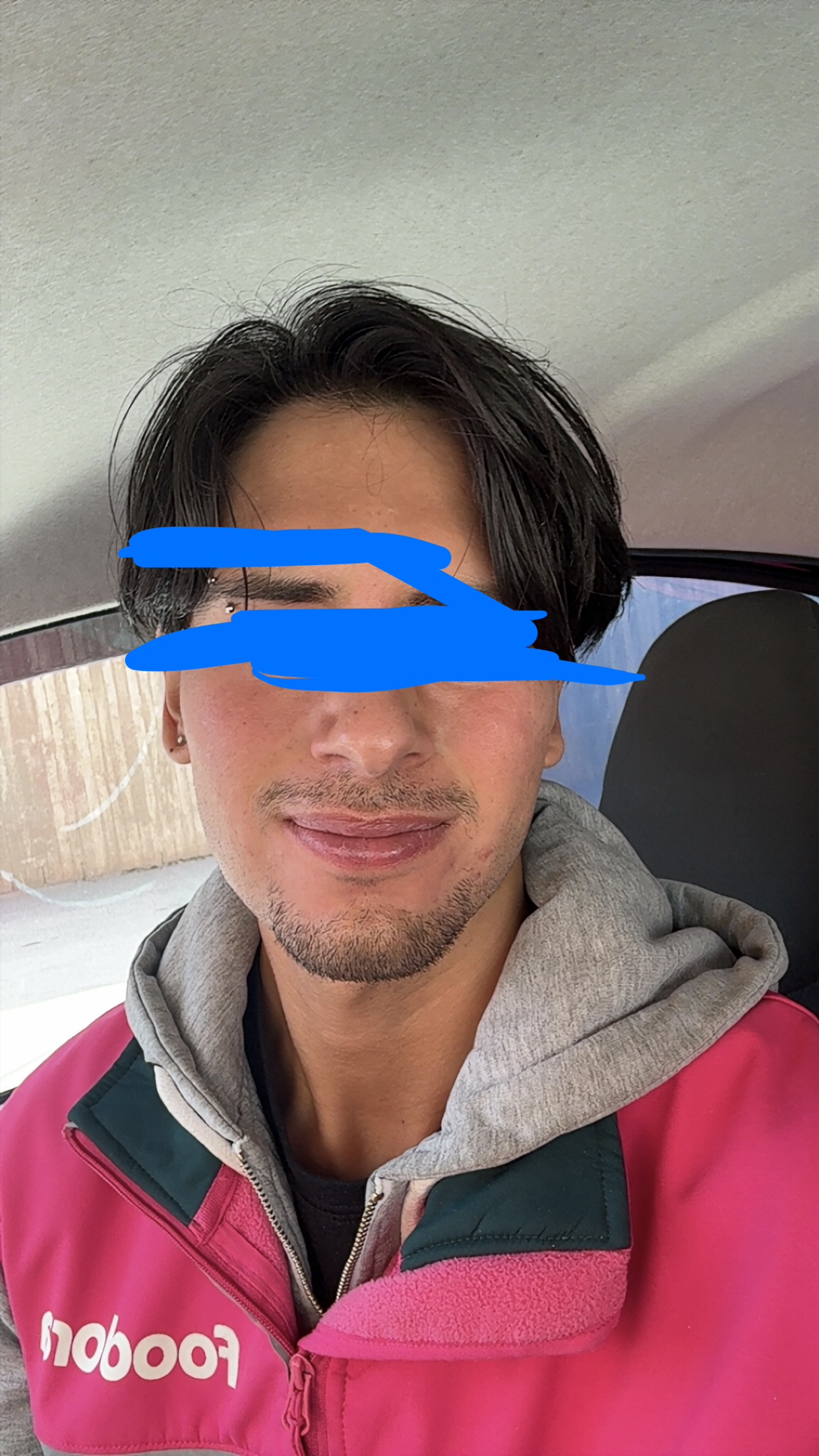 Just had buccal fat removal | Looksmax.org - Men's Self-Improvement ...